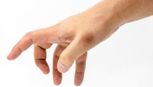Trigger Finger - Penyebab, Gejala, Pengobatan