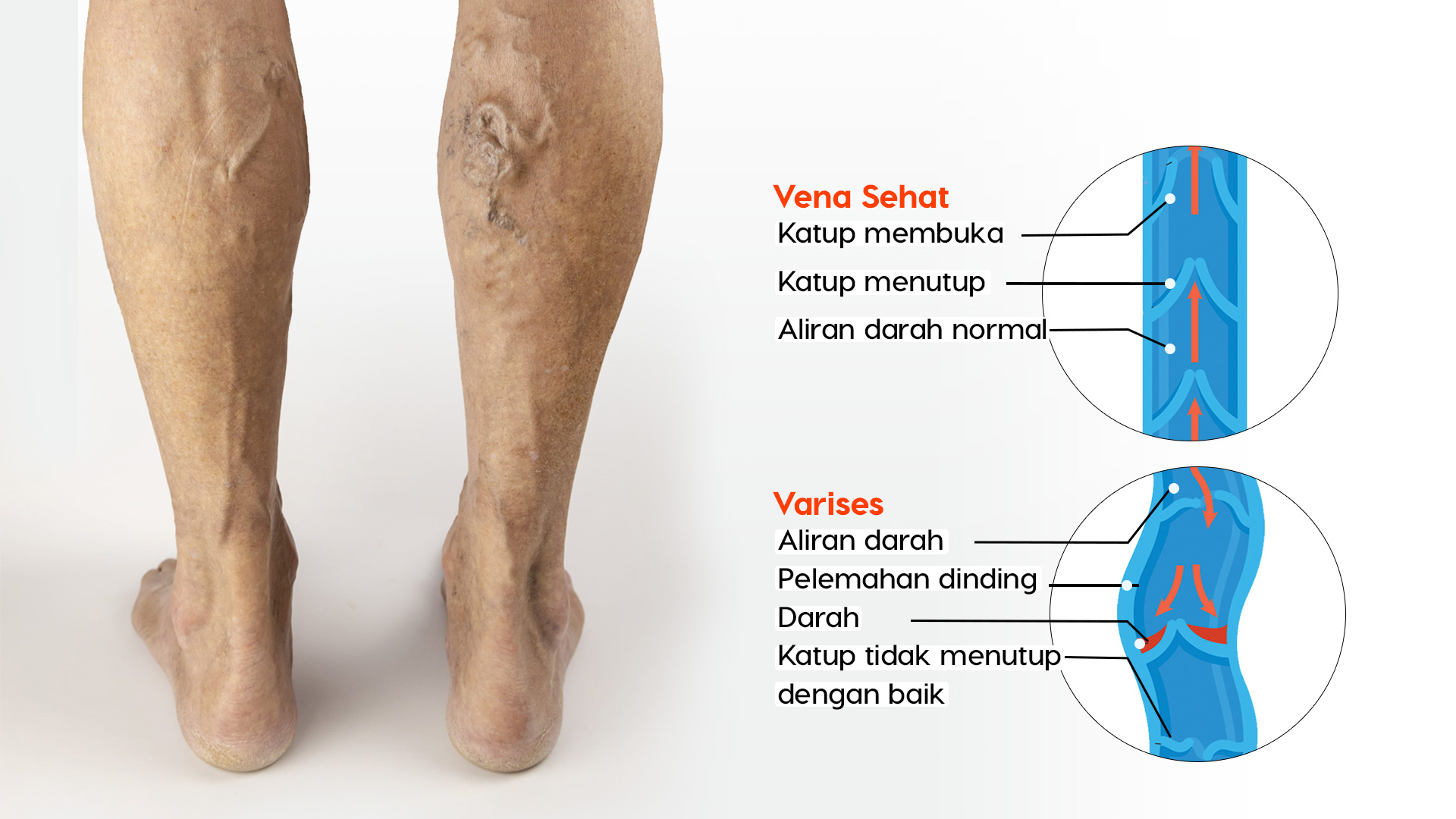 Metode Laser Penghilang Varises Tanpa Bedah - Mandaya Hospital Group