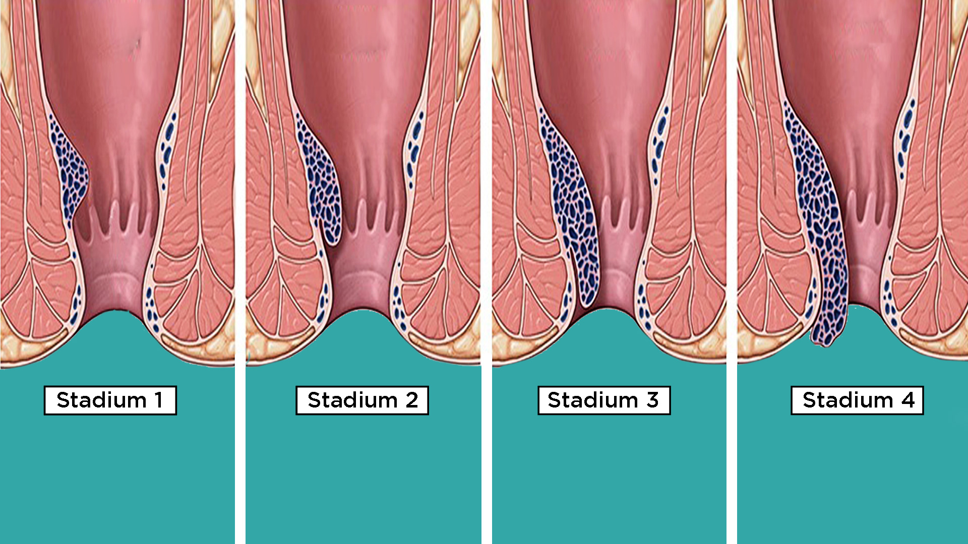 Atasi Wasir Minimal Nyeri Dengan Laser Hemorrhoid - Mandaya Hospital Group