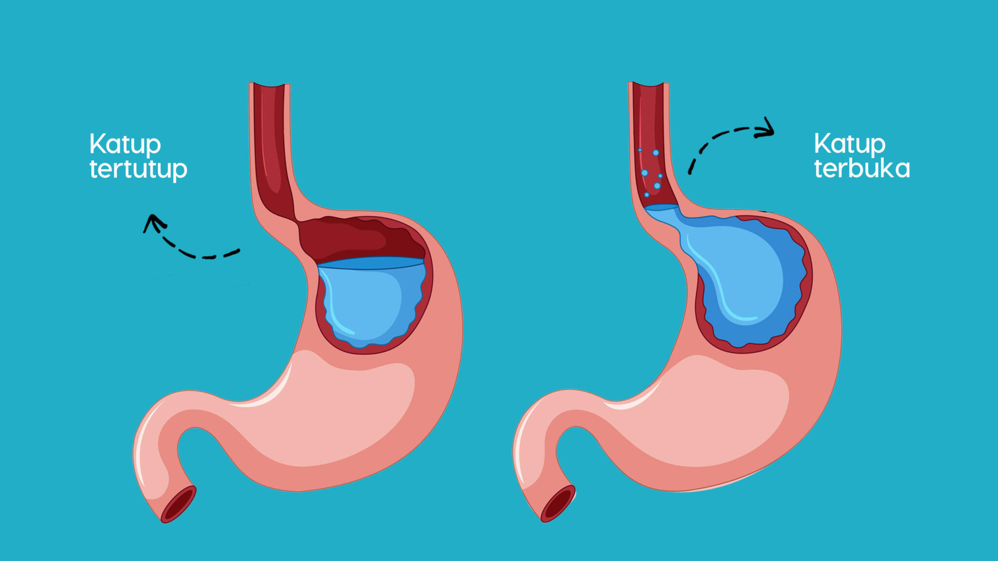 Penyakit GERD : Gejala & Pengobatan Tepat - Mandaya Hospital Group