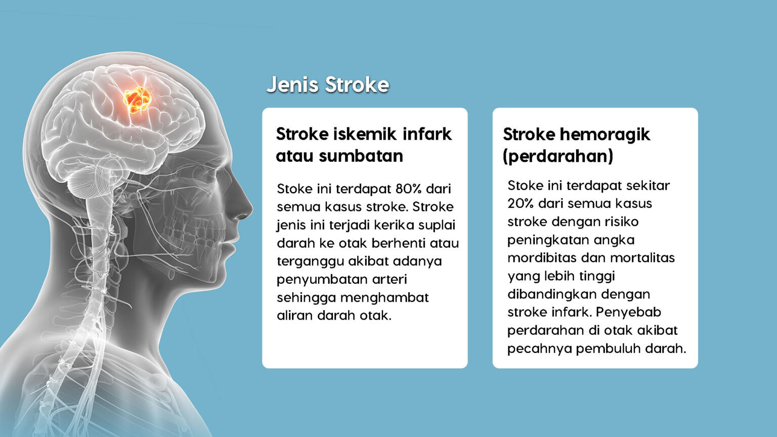 Kenali Stroke: Penyebab, Gejala, dan Cara Pencegahan - Mandaya Hospital ...