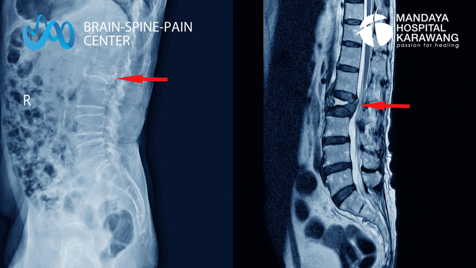 Saraf Kejepit : Gejala, Penyebab, dan Pengobatan Medis Menurut Dokter Saraf RS. Mandaya Karawang ...