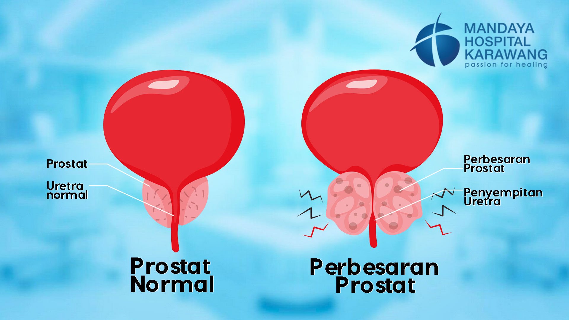 Penanganan Pembesaran Prostat di Karawang - Mandaya Hospital Group