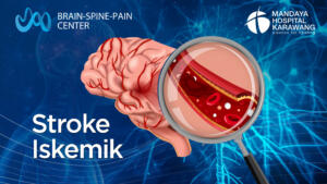 Stroke Iskemik: Gejala, Penyebab, dan Penanganan Dini - Mandaya ...