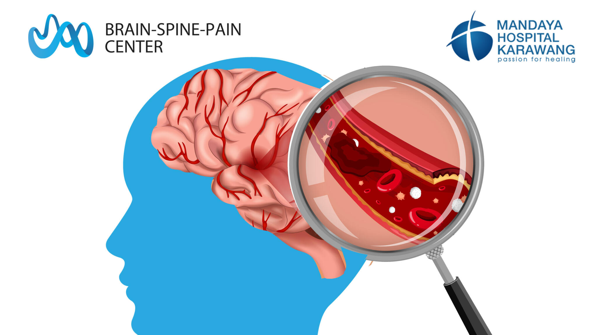 Stroke Iskemik: Gejala, Penyebab, dan Penanganan Dini - Mandaya ...