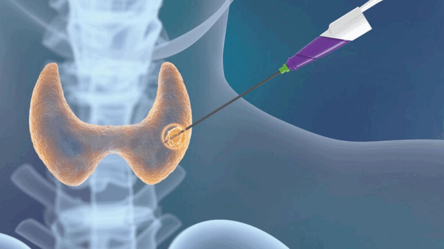 Memahami Nodul Tiroid dan Penanganannya di RS Mandaya Puri - Mandaya ...
