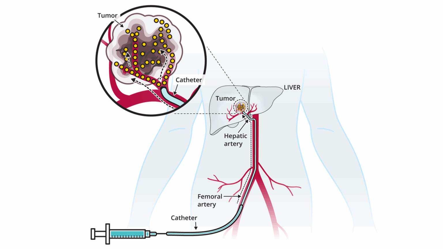 Through 3D Imaging Technology, dr. Sugi Treats Liver Cancer with TACE ...
