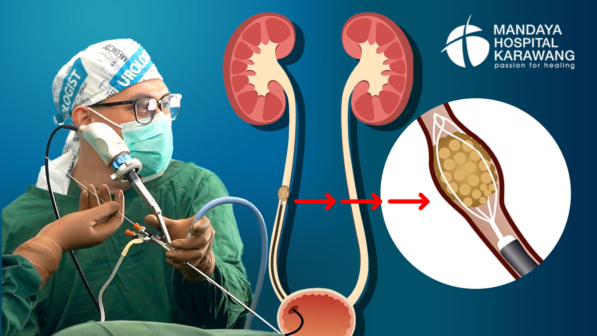 URS (Ureteroscopy) Cara Modern Atasi Batu Ureter Tanpa Pembedahan Di ...