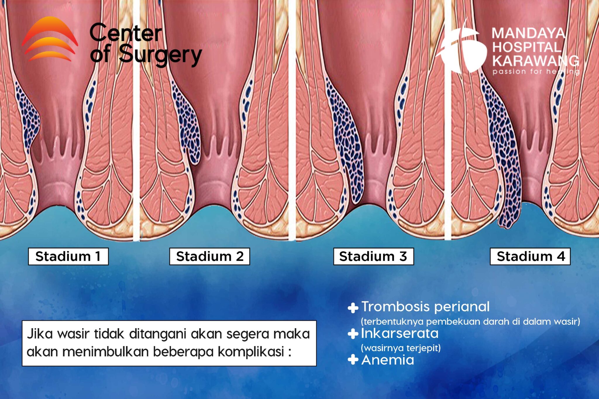 Dokter Spesialis Bedah Karawang Tangani Ambeien (Wasir) dengan Laser ...