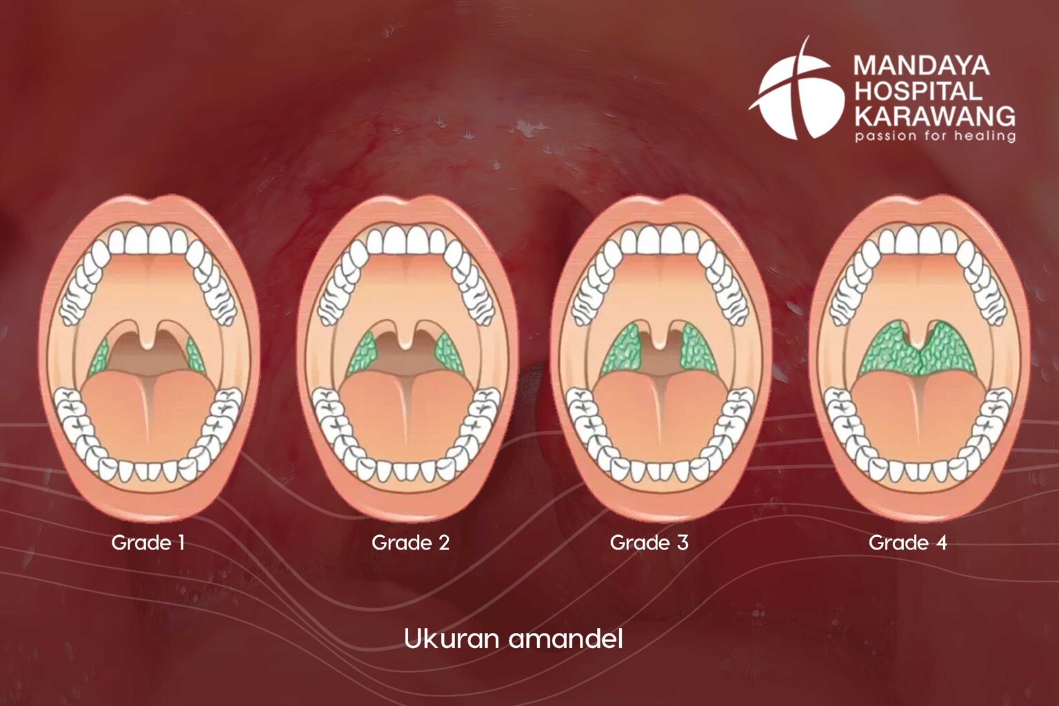 Tanda Amandelmu Perlu Penanganan Dokter THT RS Mandaya Karawang ...