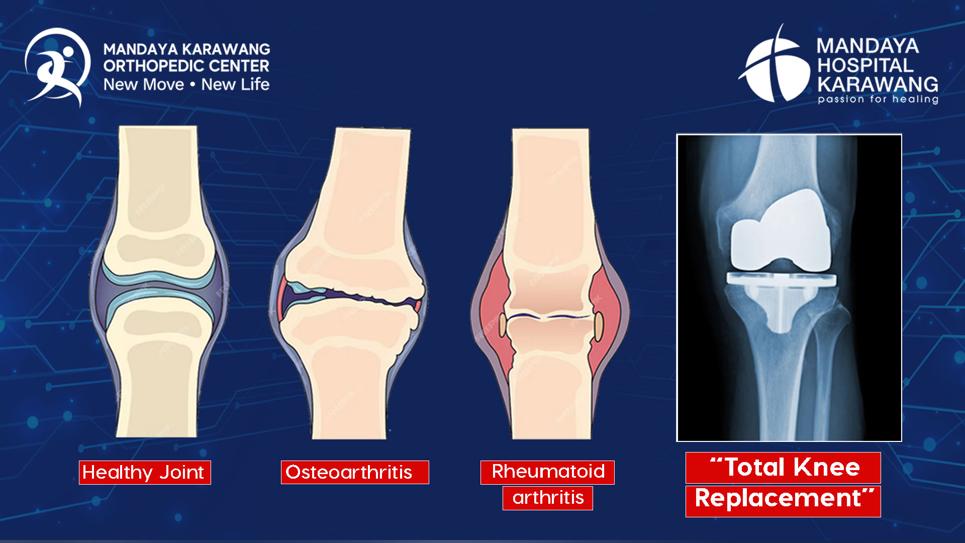 Atasi Nyeri Lutut dan Osteoartritis dengan Total Knee Replacement di RS ...