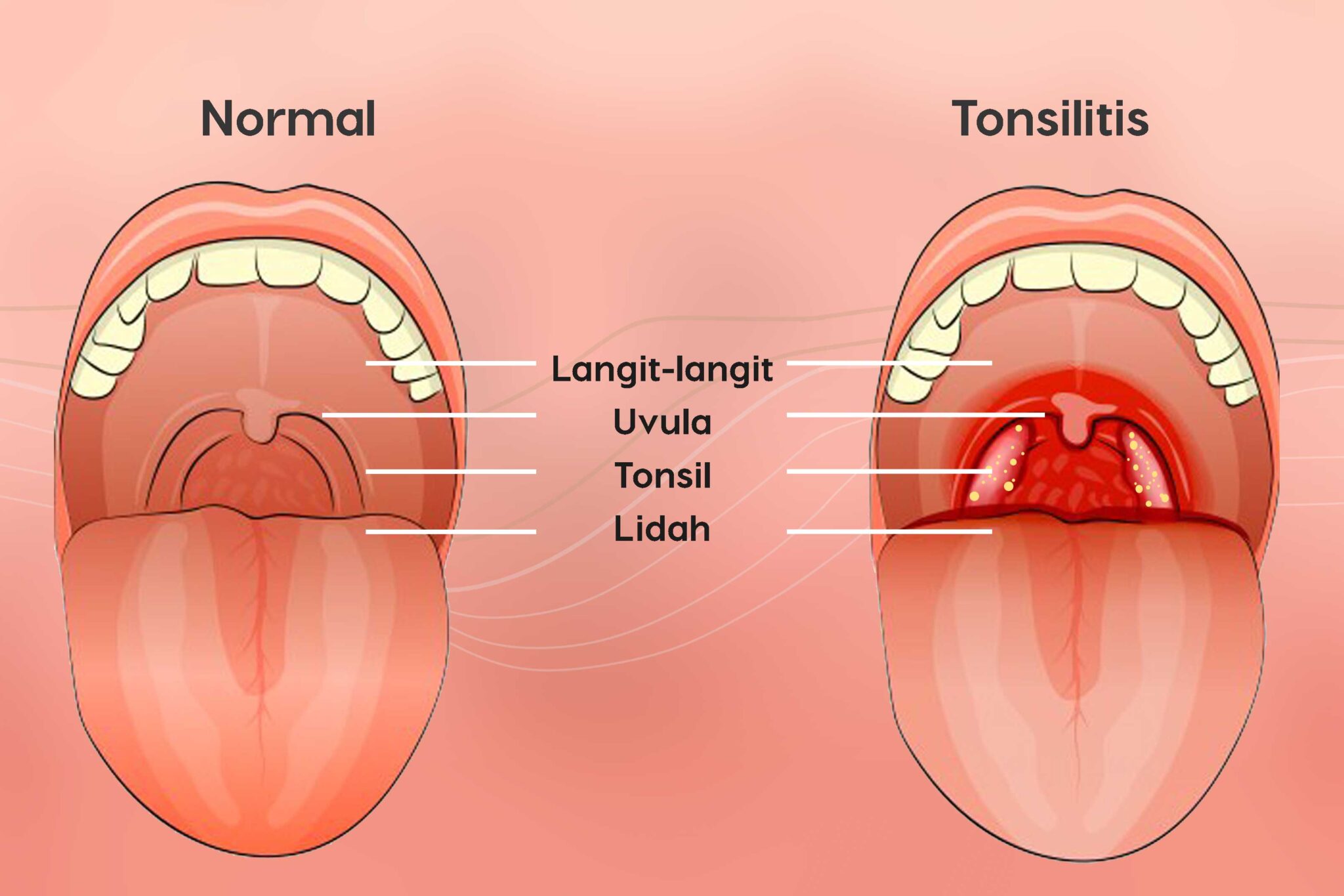 Kenali Radang Amandel (Tonsilitis): Penyebab, Gejala & Penanganannya ...