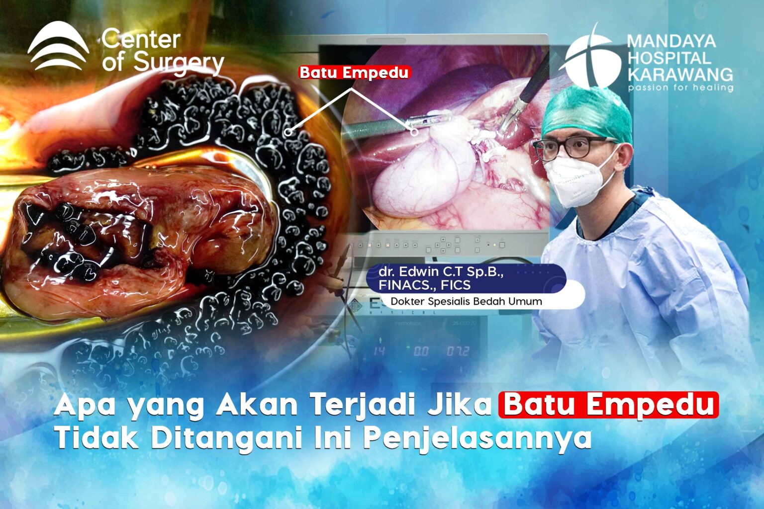 Apa yang Akan Terjadi Jika Batu Empedu Tidak Ditangani? Ini ...