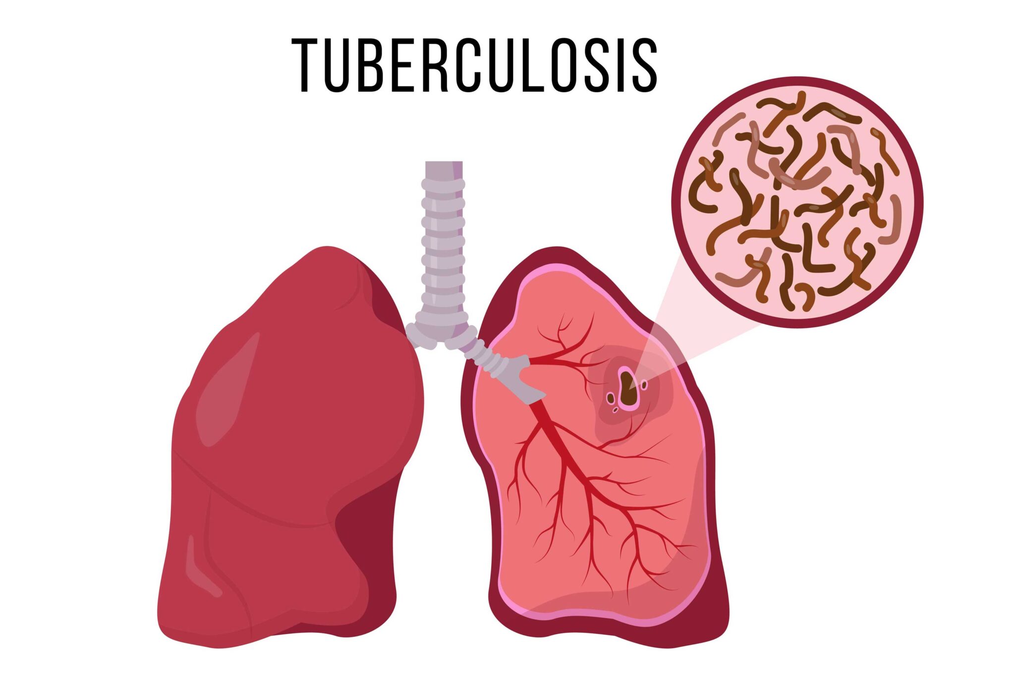 Tuberkulosis (TBC) Penyakit Menular yang Bisa Disembuhkan Namun ...