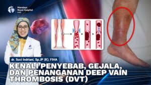 Bengkak Kaki yang Berbahaya: Mengenal Deep Vein Thrombosis (DVT ...