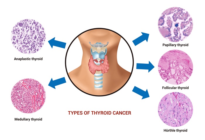 6 Thyroid Cancer Treatment Options Available at Mandaya Royal Hospital ...