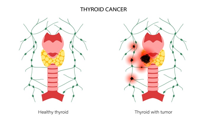 6 Thyroid Cancer Treatment Options Available at Mandaya Royal Hospital ...